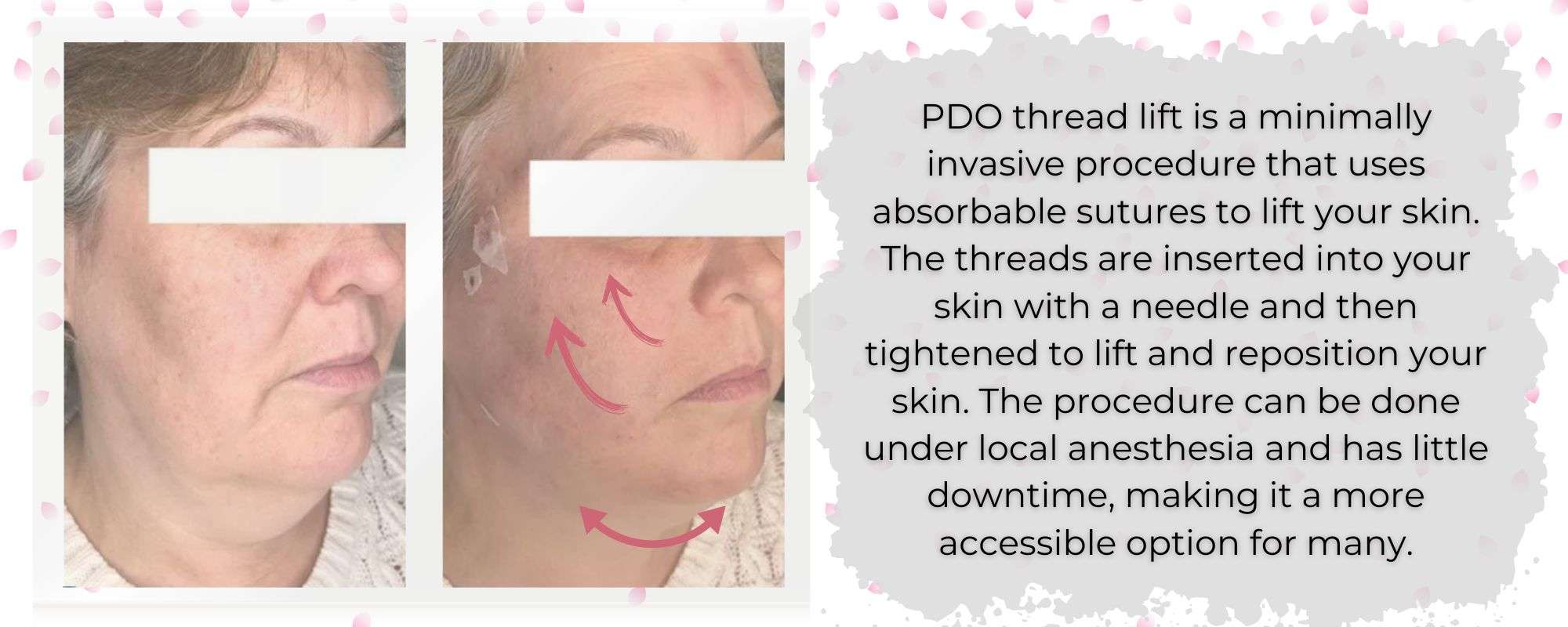 Lifting Your Way to a More Youthful Appearance: Is PDO Thread Lift the ...